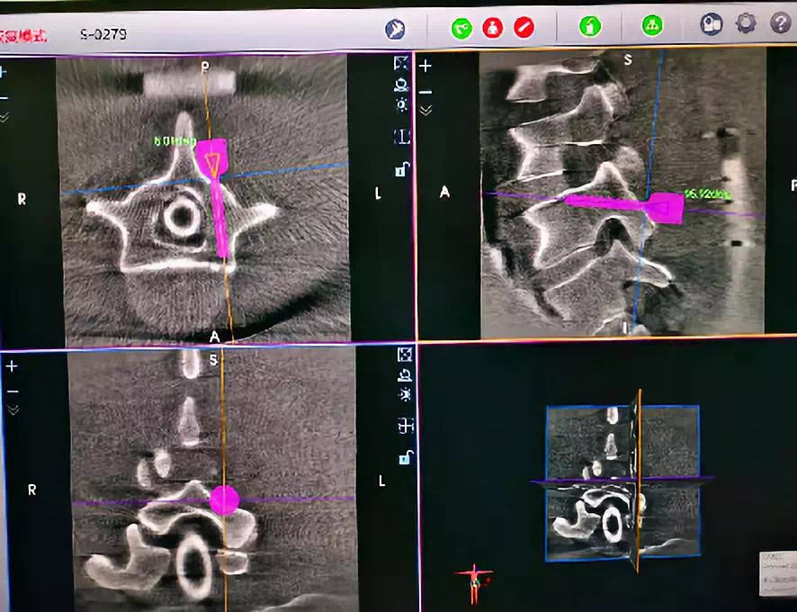 北京朝阳医院骨科完成首例天玑机器人辅助MIDLF微创手术__凤凰网