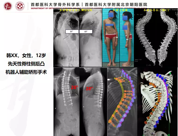 北京朝阳医院骨科完成首例天玑机器人辅助MIDLF微创手术__凤凰网
