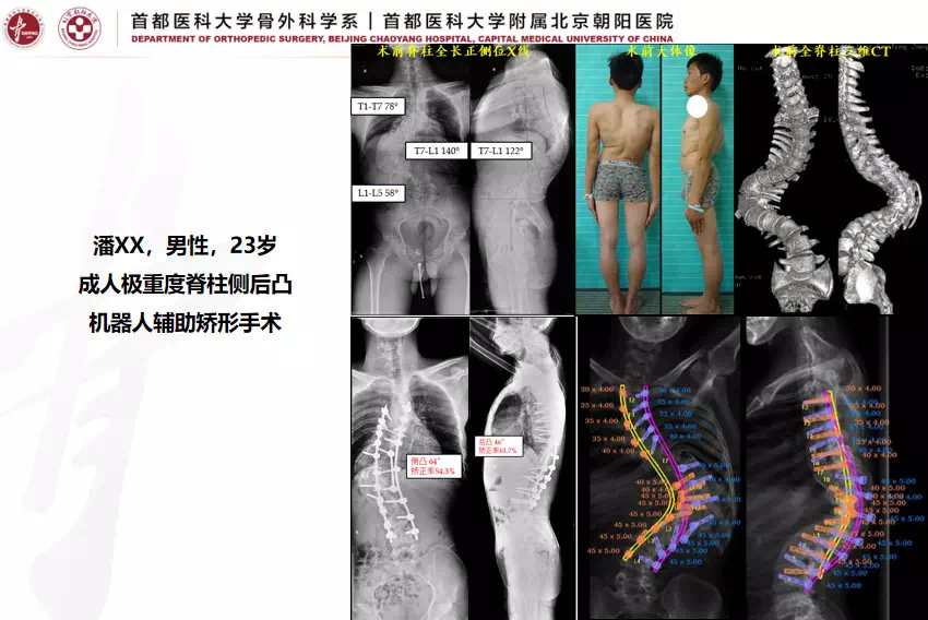 北京朝阳医院骨科完成首例天玑机器人辅助MIDLF微创手术__凤凰网